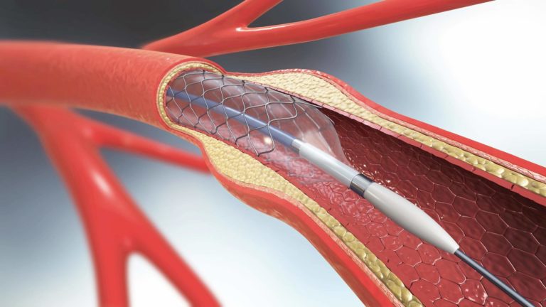 Peripheral Arterial Disease (PAD) | Palm Vascular Centers