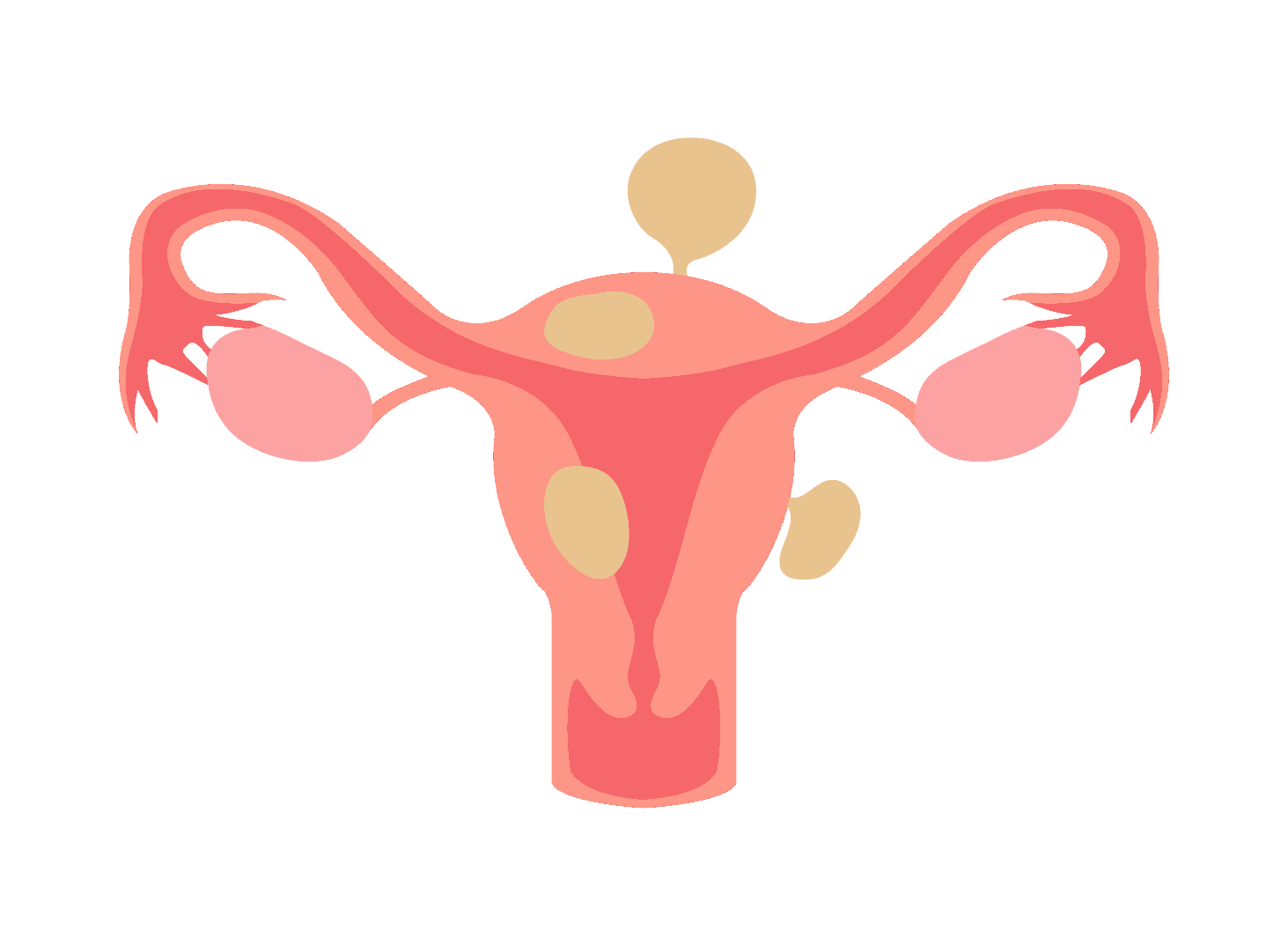 Uterine Fibroids Palm Vascular Centers Uterine Fibroids Palm Vascular Centers